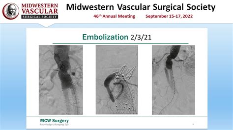 Coil Embolization Of Persistent Type 1a Endoleak Midwestern Vascular