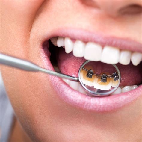 Incognito Braces Incognito Braces Cost Get Free Consultation