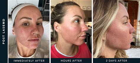 The Truth About Lasemd Before And After — That Boujee Bohemian
