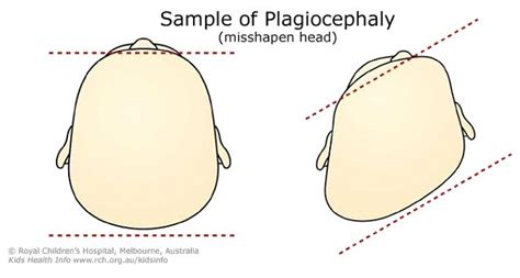 Flat Head Plagiocephaly Fairway Chiropractic Center