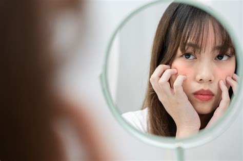 젊은 여성 아시아 얼굴이 걱정됩니다 피부과와 화장품의 스테로이드에 알레르기가 있습니다 민감한 피부 햇볕에 탄 붉은 얼굴 여드름 화학 물질에 알레르기 얼굴에 발진 피부