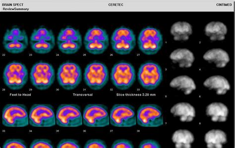 Medicina Nuclear Spect Cerebral