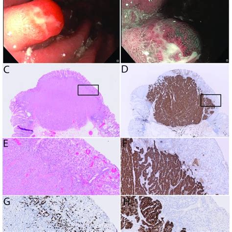 Endoscopic Appearance Of A Polyp Located At The Major Curvature With