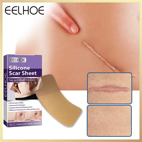 1box 8pcs 스킨 톤 흉터 스티커 보이지 않는 실리콘 흉터 제거 패치 시트 화상 복구 젤 소프트 수술 자기 접착제