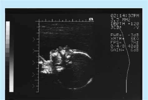 Mode Brightness Scanning B Scan Ultrasonogram Image Szabo 2004 Download Scientific Diagram
