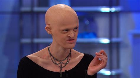 Ectodermal Dysplasia Melanie