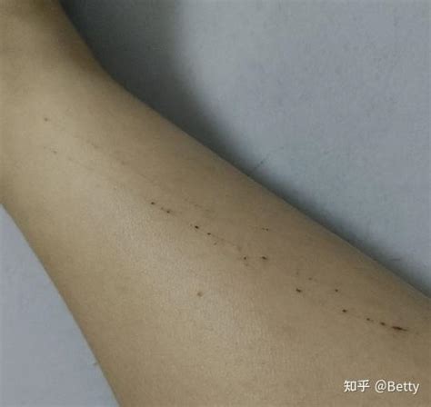 早上醒来身上出现划痕 伤痕 知乎
