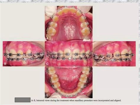 Torque In Orthodontics PPTX