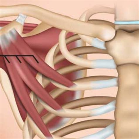 Pectoralis Minor Trigger Point Release Therapy Anatomy Pectoralis