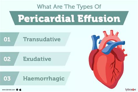 Pericardial Effusion Causes Symptoms Treatment And Cost