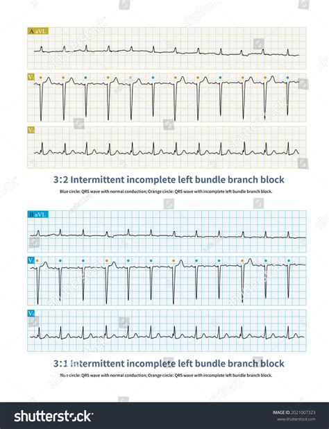Incomplete Left Bundle Branch Block 32 Stock Illustration 2021007323 Shutterstock
