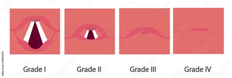 Cormack Lehane System To Assess The Airway Dificulty In Intubation Cormack Lehane System To Assess The Airway Dificulty In Intubation