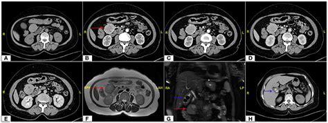 Frontiers Case Report Totally Laparoscopic Resection Of Retroperitoneal Paraganglioma