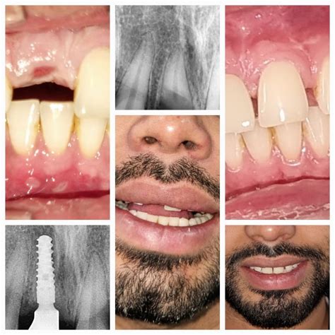 Suresh Kannan Prabakaran On Linkedin Missing Teeth Affects 1 Smile 2 Certain Letter