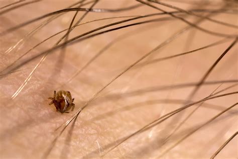 Scabies Chiggers Symptoms And How To Identify Each 40 Off