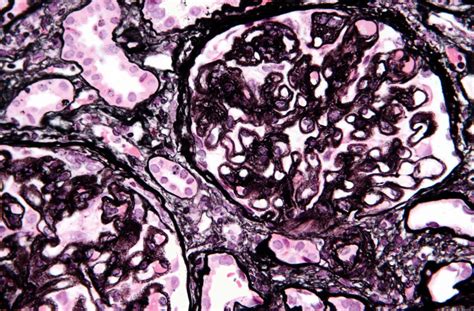 Nephrotic Syndrome What Is Nephrotic Syndrome