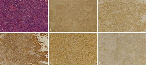 Primary Intramedullary Primitive Neuroectodermal Tumor A Case Report And Review Of The