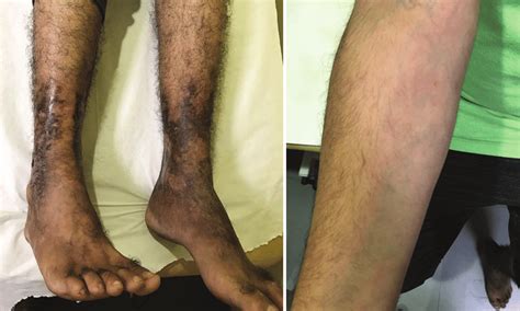 A Hyperpigmentation And Healed Ulcers With Scarring On Both Legs B Download Scientific