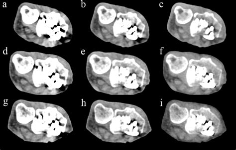 Figure 5 From Comparison Of Bone Evaluation And Metal Artifact Between Photon Counting Ct And