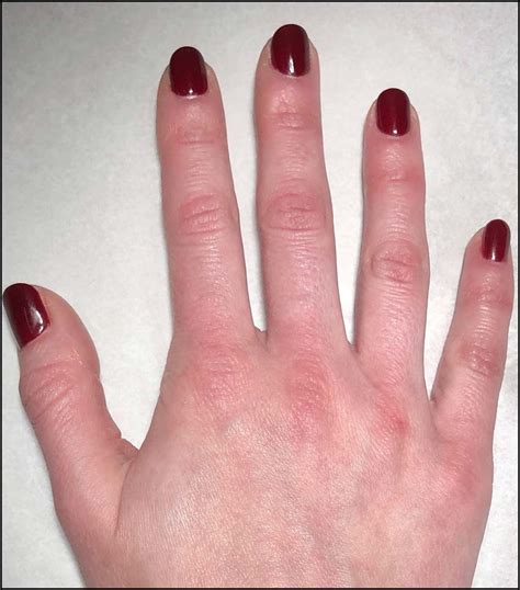 Right Index Finger And Fifth Digit Synovitis While On Vedolizumab And