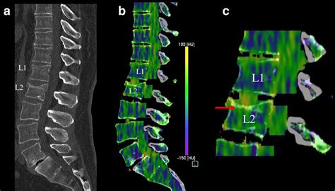 47 Year Old Male With Traumatic Lumbar Pain And Acute Compression Download Scientific Diagram
