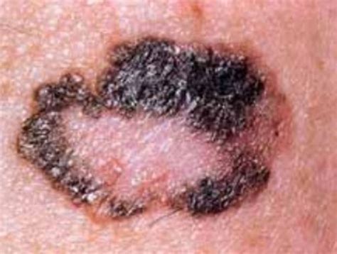 점이 아니라 암이라고 이런 점 있다면 피부암 의심