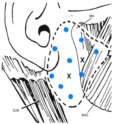 Sialorrhea Anatomy Pathophysiology And Treatment With Emphasis On The