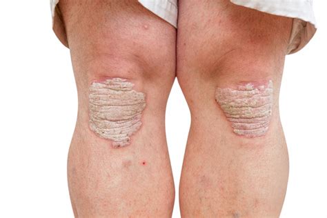 Psoriasis Citrine Healthcare Ltd