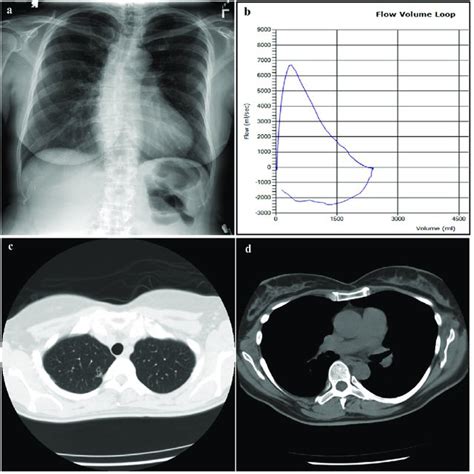 A Normal Cxr B Flow Volume Loop With Flattening Of Inspiratory Limb Download Scientific