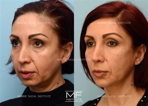 Complete Facial Rejuvenation Or Contouring Before And After Pictures
