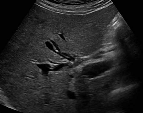 Abdomen And Retroperitoneum 12 Gallbladder And Bile Ducts Case 12