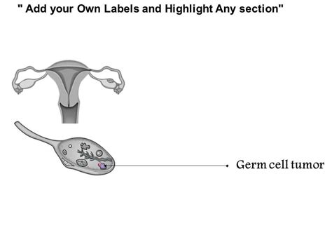 Ovarian Cancer Medical Images For Powerpoint PowerPoint Templates Backgrounds Template