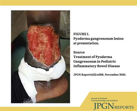 Pyoderma Gangrenosum Gutsandgrowth