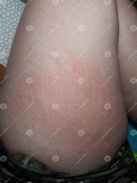 Skin On The Legs Psoriasis Rashes Eczema And Other Skin Conditions