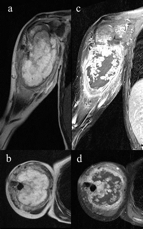 Figure 1 From Secondary Chondrosarcoma Of The Proximal Part Of The Humerus Arising In A Four