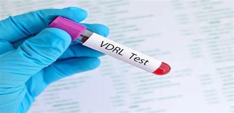 Vdrl Test For Syphilis Fast And Accurate Screening Prognohealth