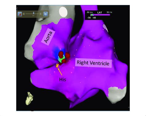 Electroanatomic Mapping Showing Rf Application Points On The Ncc Note Download Scientific