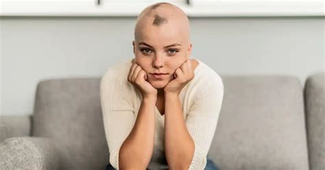 Ophiasis Alopecia A Rare Type Of Hair Fall Condition