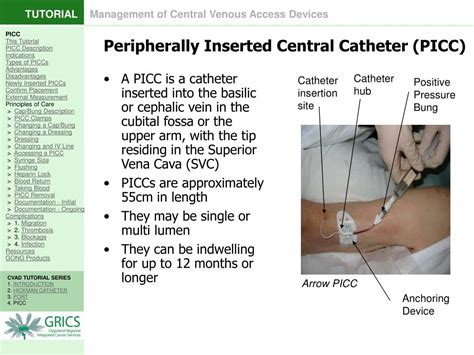 Ppt 4 Peripherally Inserted Central Catheter Picc Powerpoint Presentation Id 735059
