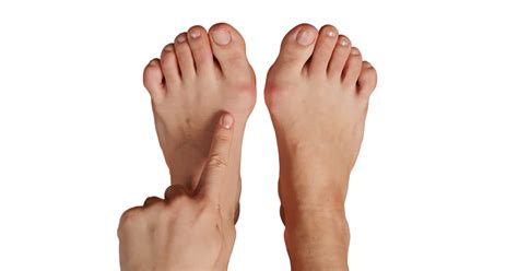 Hallux Valgus Misalignment Of The Big Toe