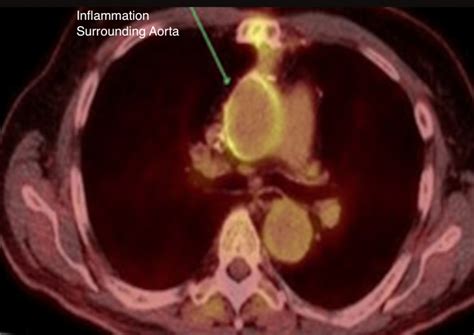 Cardiology Rheumatology Intersections In Aortitis And Aortic Aneurysms