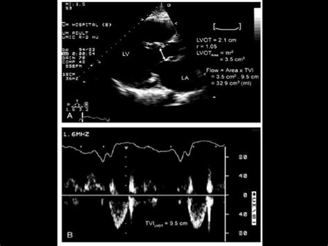 Normal Lv Systolic Function In Hindi Normal Lv Systolic Function In Hindi