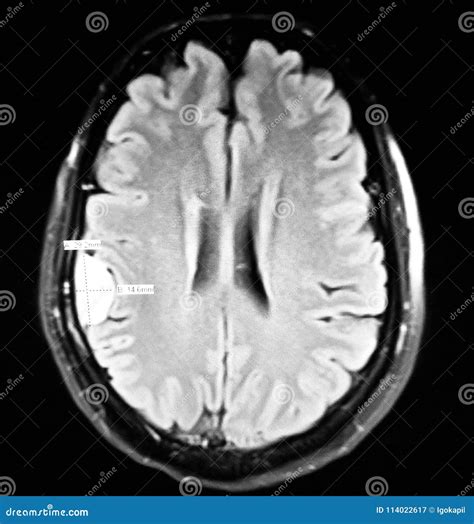 Mri Brain Inferior Frontal Dnet Structure Collage Stock Image 67289161