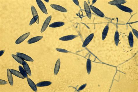 Tinea Cruris Microscope