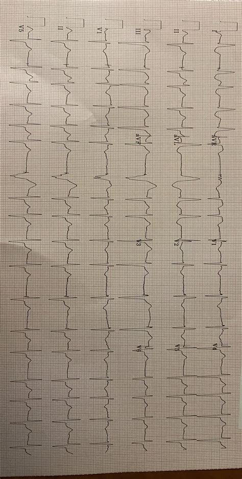 Elevation In Avr R Ekgs
