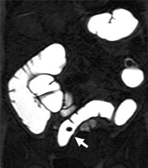 A Source Image Of Mrc With A Pedunculated Polyp Of The Sigmoid Colon Download Scientific