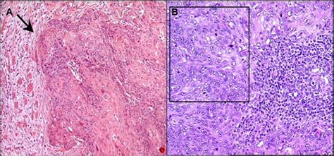 A Histopathological Analysis Of Cervical Tissue Nests Of Neoplastic