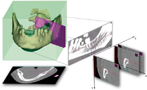 Figure 1 From Jaw Tissues Segmentation In Dental 3d Ct Images Using Fuzzy Connectedness And