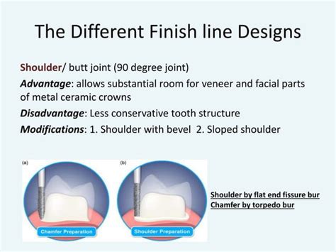 Design Of A Fixed Partial Denture With Abutment Tooth Preparation Pptx Dental Health