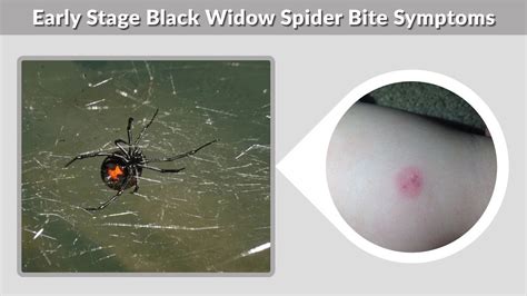 Black Widow Spider Bite Stages Timeline Symptoms And Care